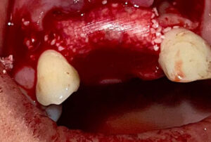 Real-World Applications of GBR in Dental Implantology - American Dental ...