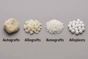 Selecting the Right Bone Graft Material: Autografts, Allografts, and ...