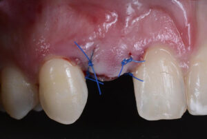 When to Use Different Flap Techniques in Implant Dentistry - American ...